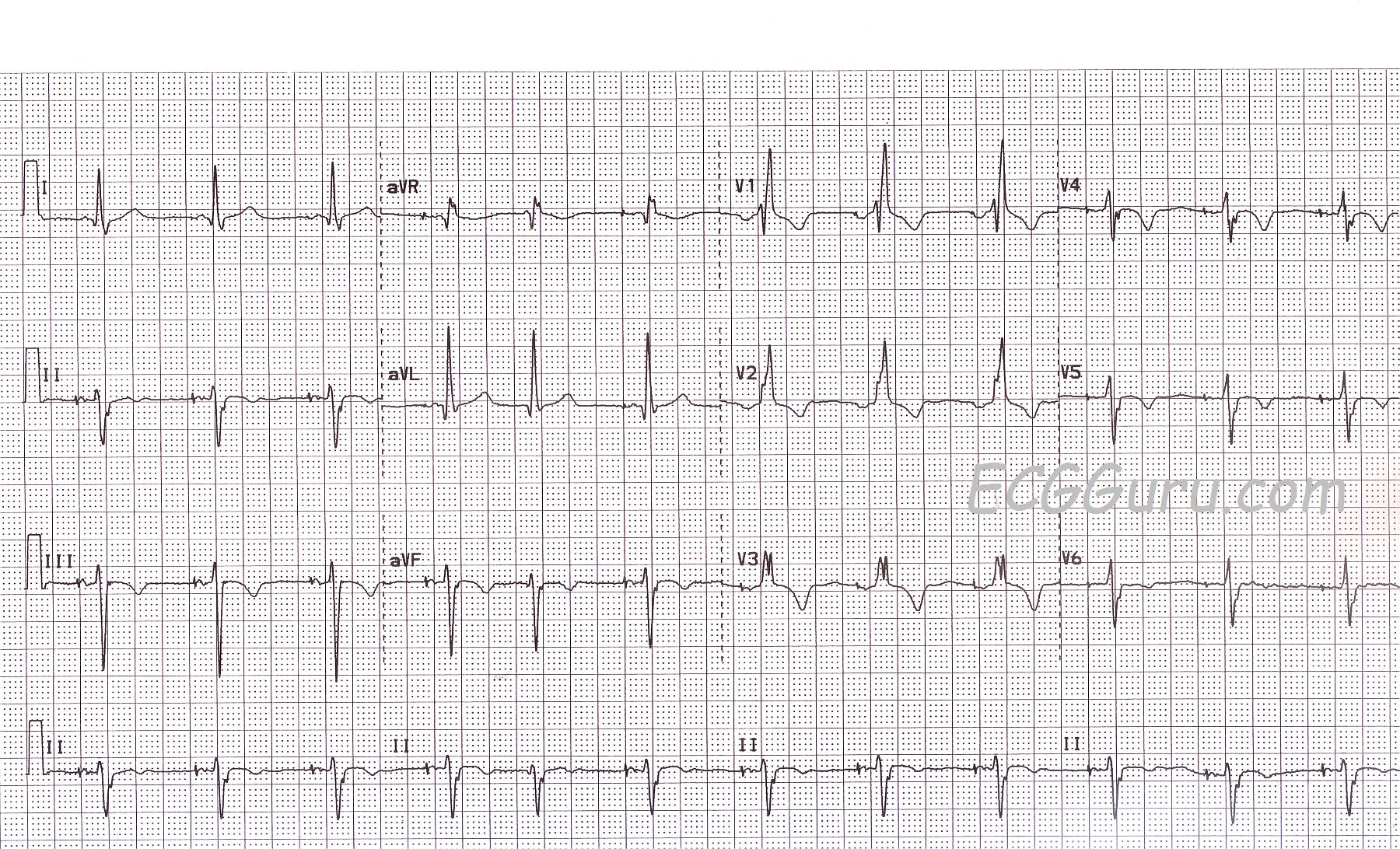 Atrial Pacing Ecg Guru Instructor Resources